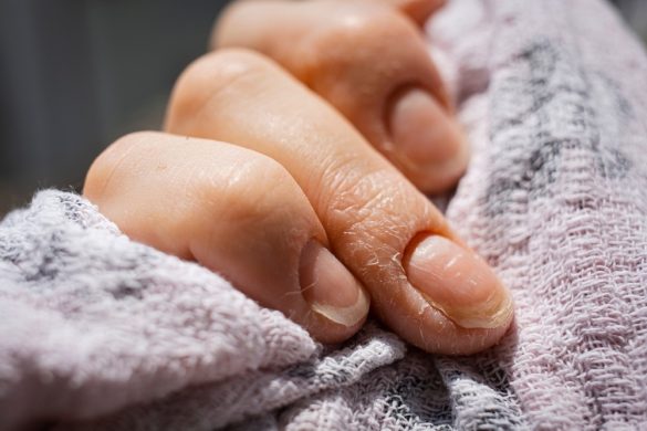 Beau's Lines 101: Causes, Treatments, and Who Is Affected - Maby Blog