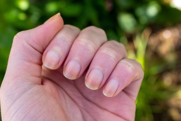 What Causes And How To Treat A Brown Spot On Your Nail - Maby Blog
