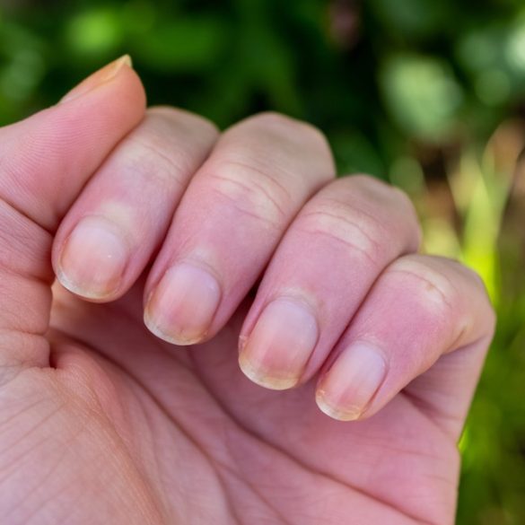 The Symptoms, Roots, and Cure for Pterygium Nails - Maby Blog